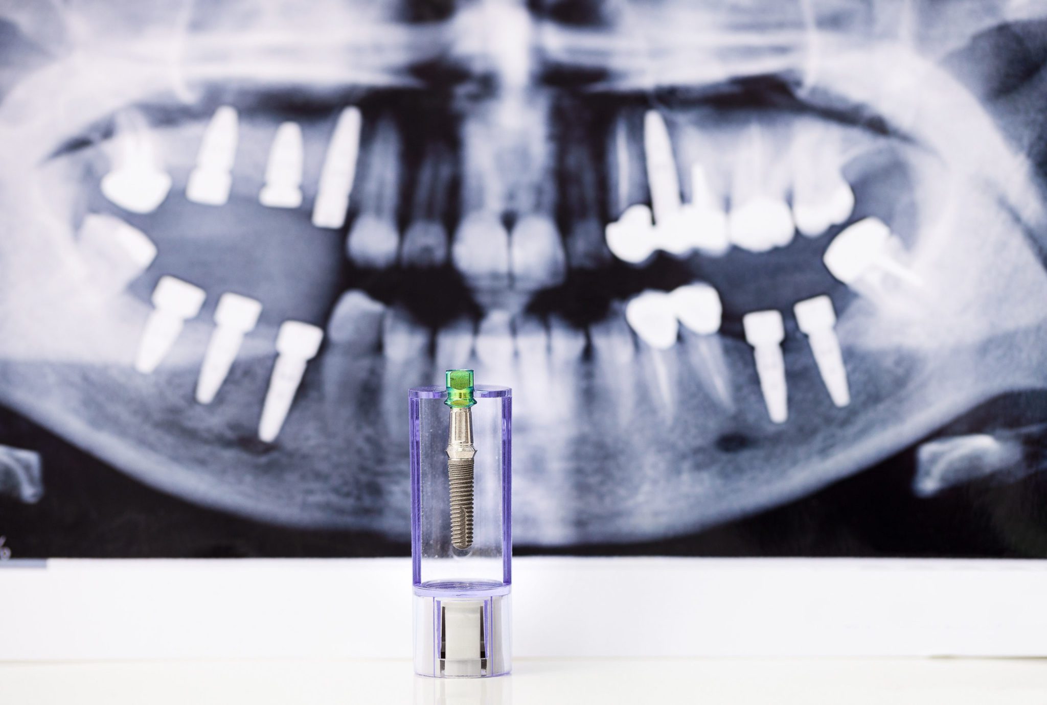 Beware: Don’t Lose Your Teeth, Get Dental Implants!