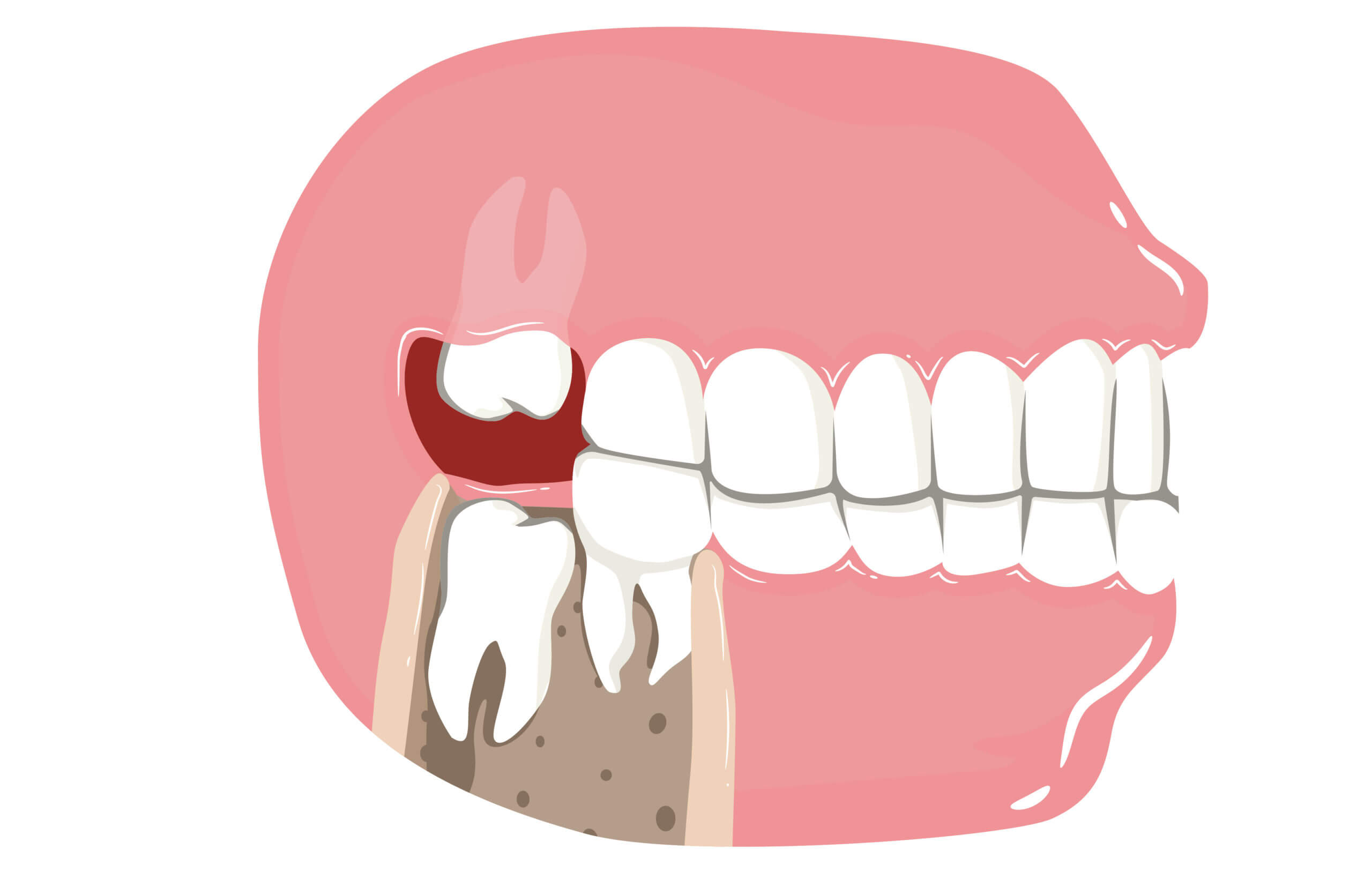 Wisdom Teeth Extractions | Antoine Dental Center