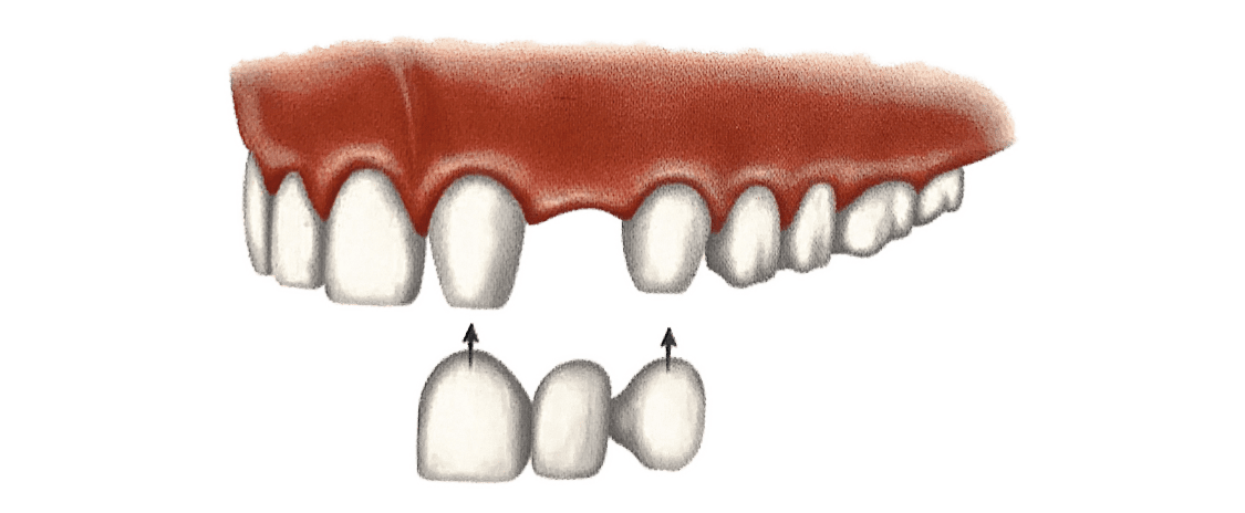 Single Tooth Replacements | Antoine Dental Center