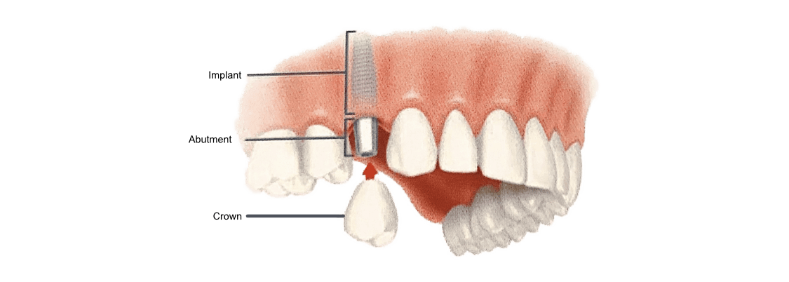 Single Tooth Replacements | Antoine Dental Center