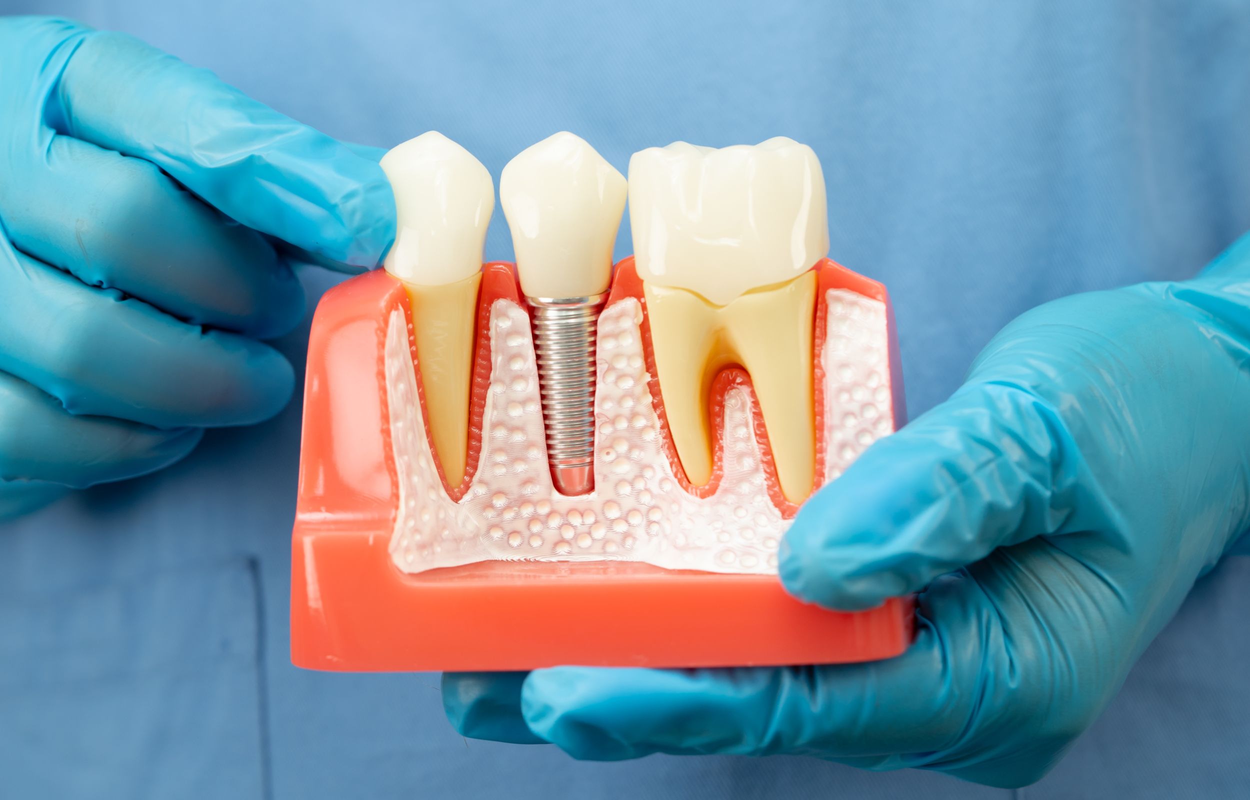 What Is a Single Dental Implant? Benefits, Process & Longevity