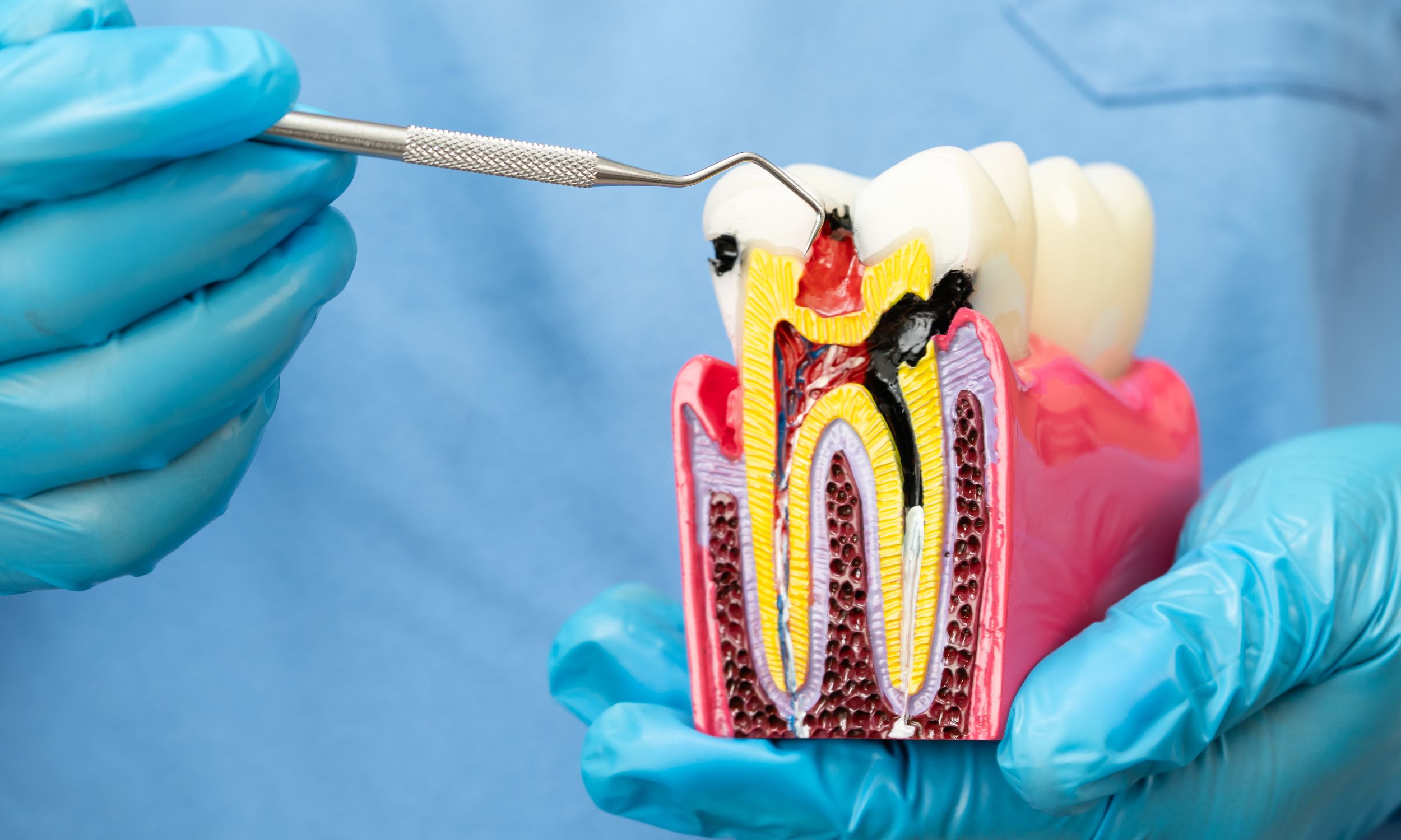 Root Canal Post Op Instructions: Pain, Diet & Care After Treatment