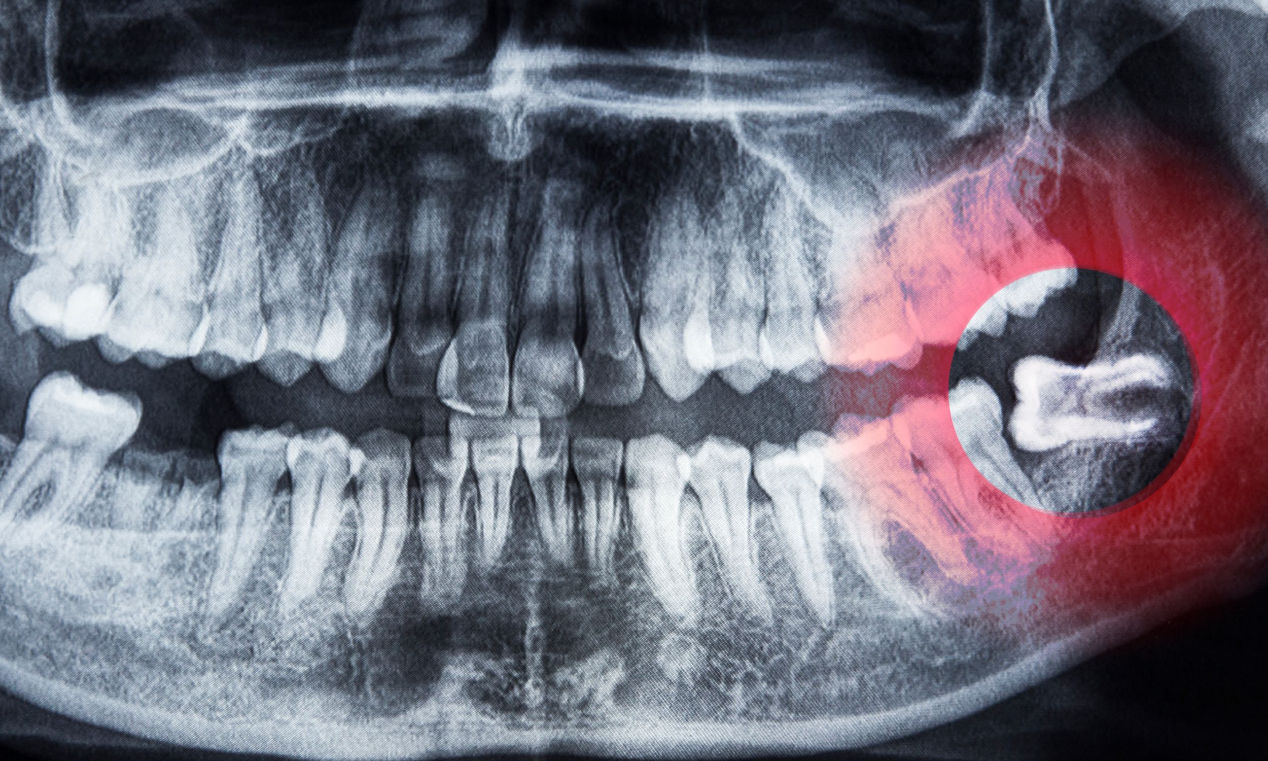 What Are Wisdom Teeth? Signs You Need Removal & Recovery