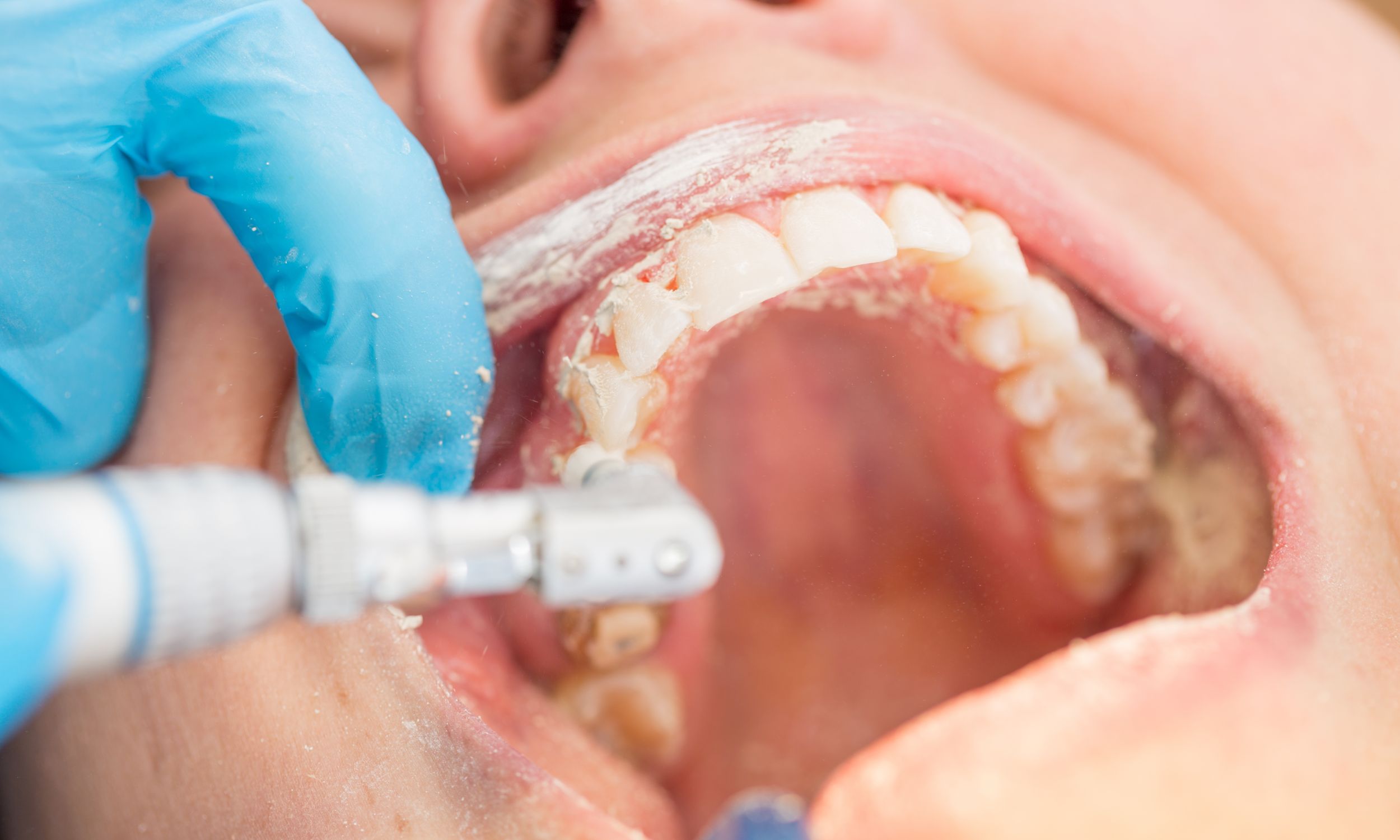 What Is a Deep Dental Cleaning? Scaling, Root Planing & Healing
